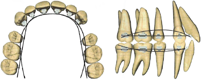 bowing effect_アートボード 1 | 世田谷区二子玉川 マウスピース矯正インビザライン｜『マウスピース矯正専門サイト』