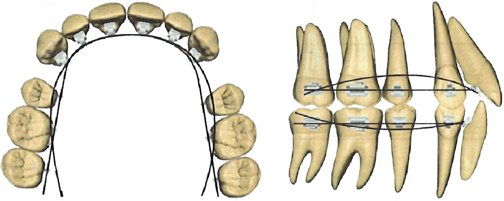 bowing effect_アートボード 1 | 世田谷区二子玉川 マウスピース矯正インビザライン｜『マウスピース矯正専門サイト』